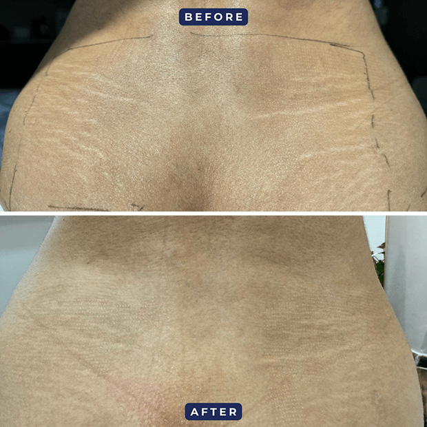 Inkless Stretch Mark Removal | No-Ink Stretch Mark Treatment